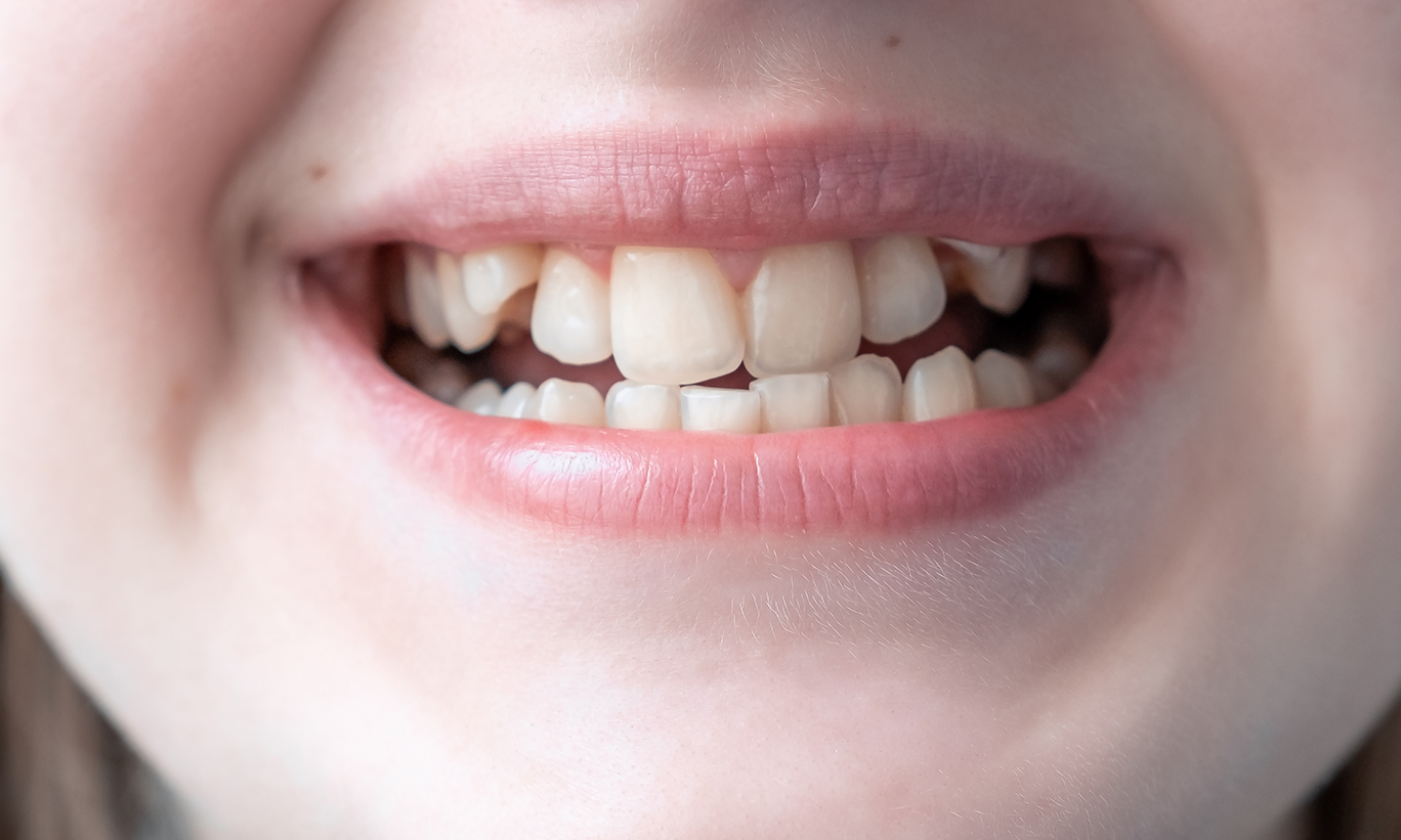 Crowding or Crooked Teeth - Embrace Orthodontics